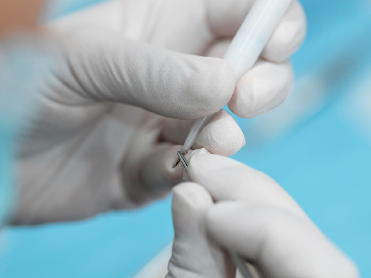 DHI Hair Transplant Turkey: Complete Guide & Cost 2026 | Clinicana